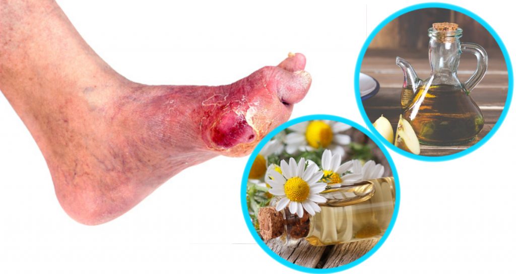 Necrotic Wound Causes and Symptoms