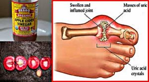 Here Is How to Eliminate Uric Acid Crystallization from Your Body to ...