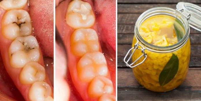 How to Heal Tooth Decay & Cavities Naturally With 3 Simple and ...