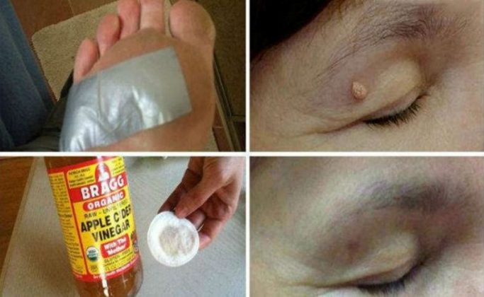 How To Easily Remove Skin Tags, Moles, Blackheads, Spots And Warts By ...
